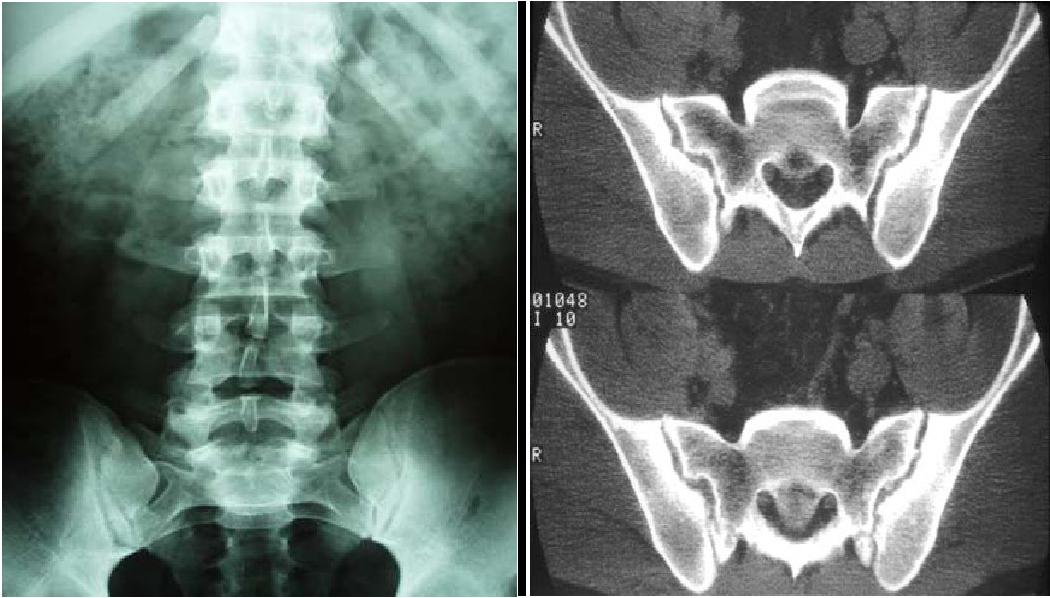 La Coxigodinia :: Salud y Medicina